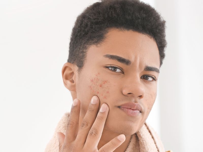 Understanding Acne with Dr Derek Phillips | Skin Insights – Clinisoothe+